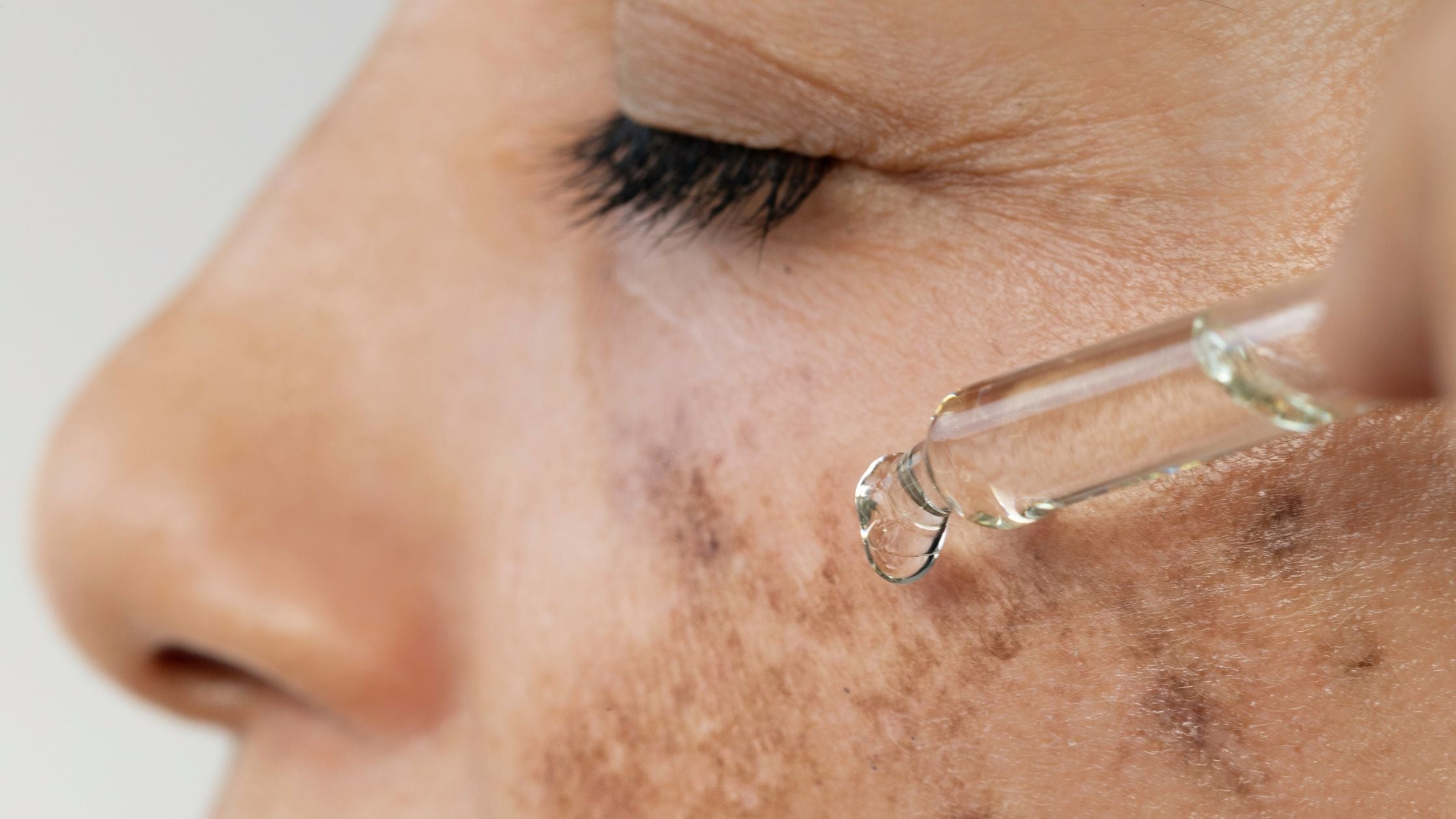 Hyperpigmentation 101: What It Is And Why It Happens – Forever Beaumore