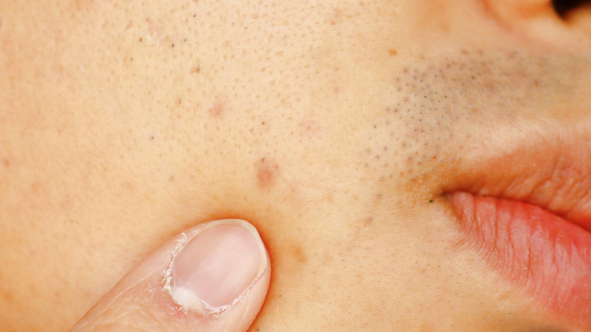 Hyperpigmentation Scars: What Causes Them and How to Get Rid of Them ...