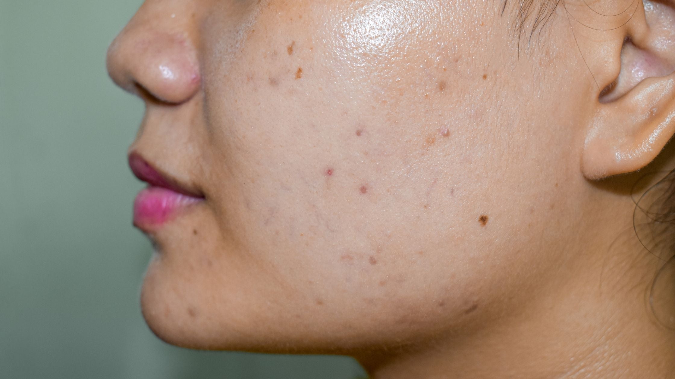 Đốm đen trên da? Đây là cách làm mờ chúng hiệu quả – Forever Beaumore